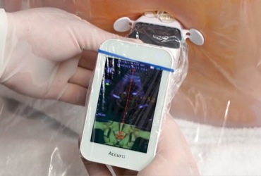 Neuraxial Guidance Device Beats Palpation-Guided Spinal Anesthesia in ...