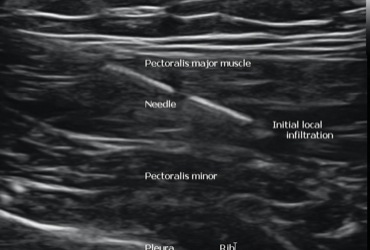 Novel INTRAPEC Injection, Erector Spinae Block Effective for Open ...