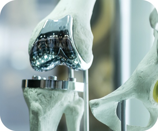 TKA Analgesia Genicular Nerve Block