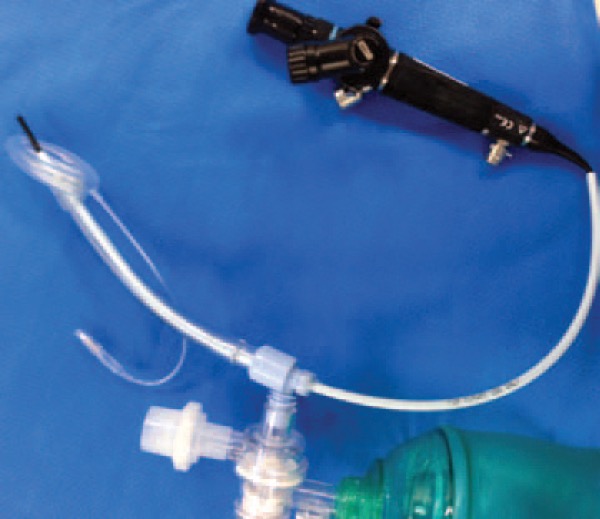 The Supraglottic Airway Device: Its Role as an Intubating Conduit