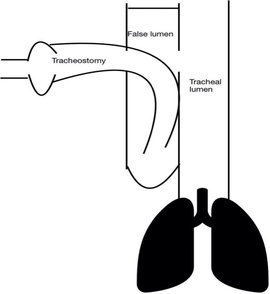 Unanticipated Difficult Airway: A Tracheostomy Is Not Always a ...