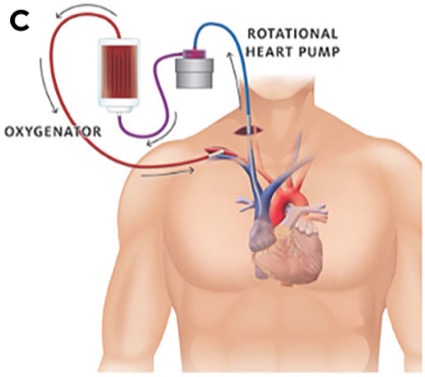 Perioperative Management of Adult Patients on Venoarterial ECMO ...