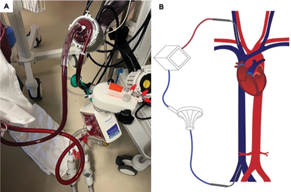 Venovenous ECMO and Its Use In Pregnancy Due to COVID-19