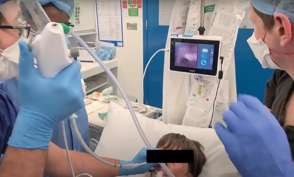 When Conscious Sedation Proves Inadequate for Intubation