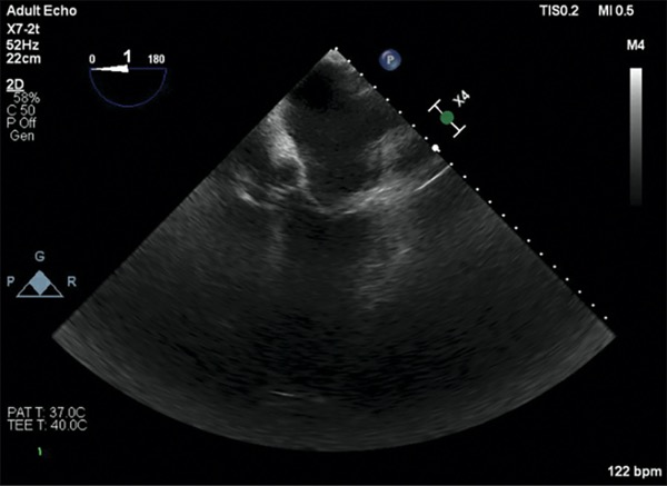Difficult TEE Probe Insertion Requiring Nasal Fiberoptic Guidance