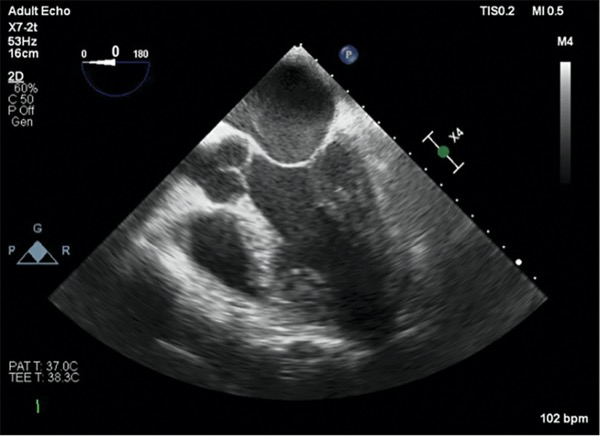 Difficult TEE Probe Insertion Requiring Nasal Fiberoptic Guidance