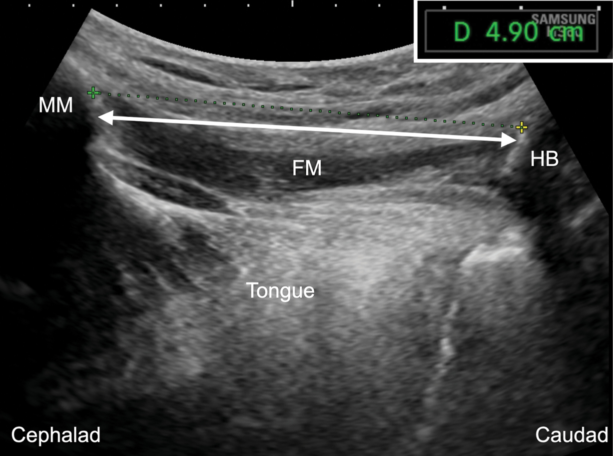 Point-of-Care Ultrasound Of the Airway