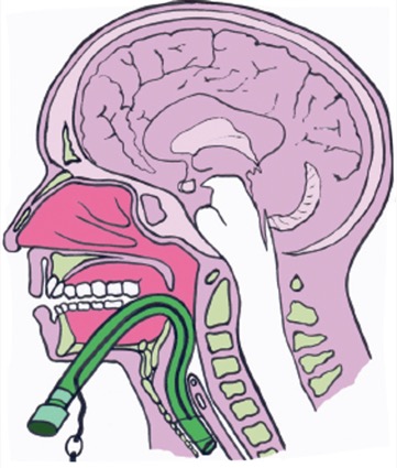 Airway Management for Craniofacial Trauma