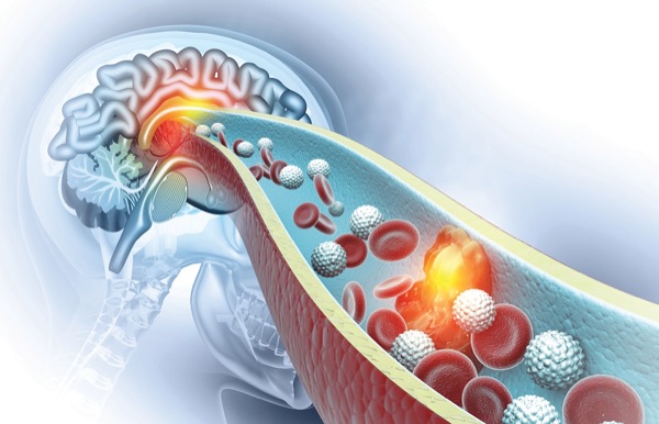 Anesthetic Management of Endovascular Thrombectomy For Acute Ischemic ...