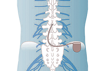 Identifying Post-op Complications of SCS Implantation