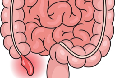 Surgery for Appendicitis: Moving Away From a Simple ‘Yes’ or ‘No’?