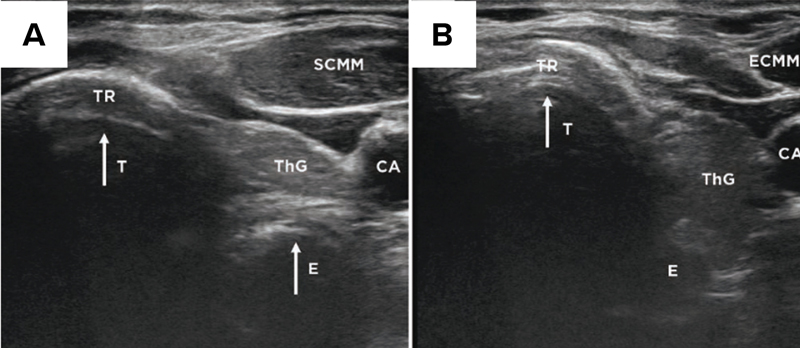 Point-of-Care Ultrasound for Upper Airway Management And Gastric Ultrasound